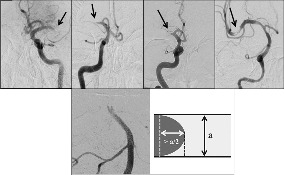 Thrombus Occlusion Pattern on Angiography – Guiding Revascularisation ...