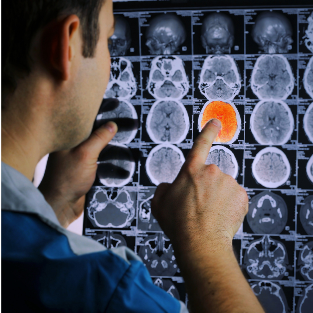 Falls After a Stroke - European Stroke Organisation