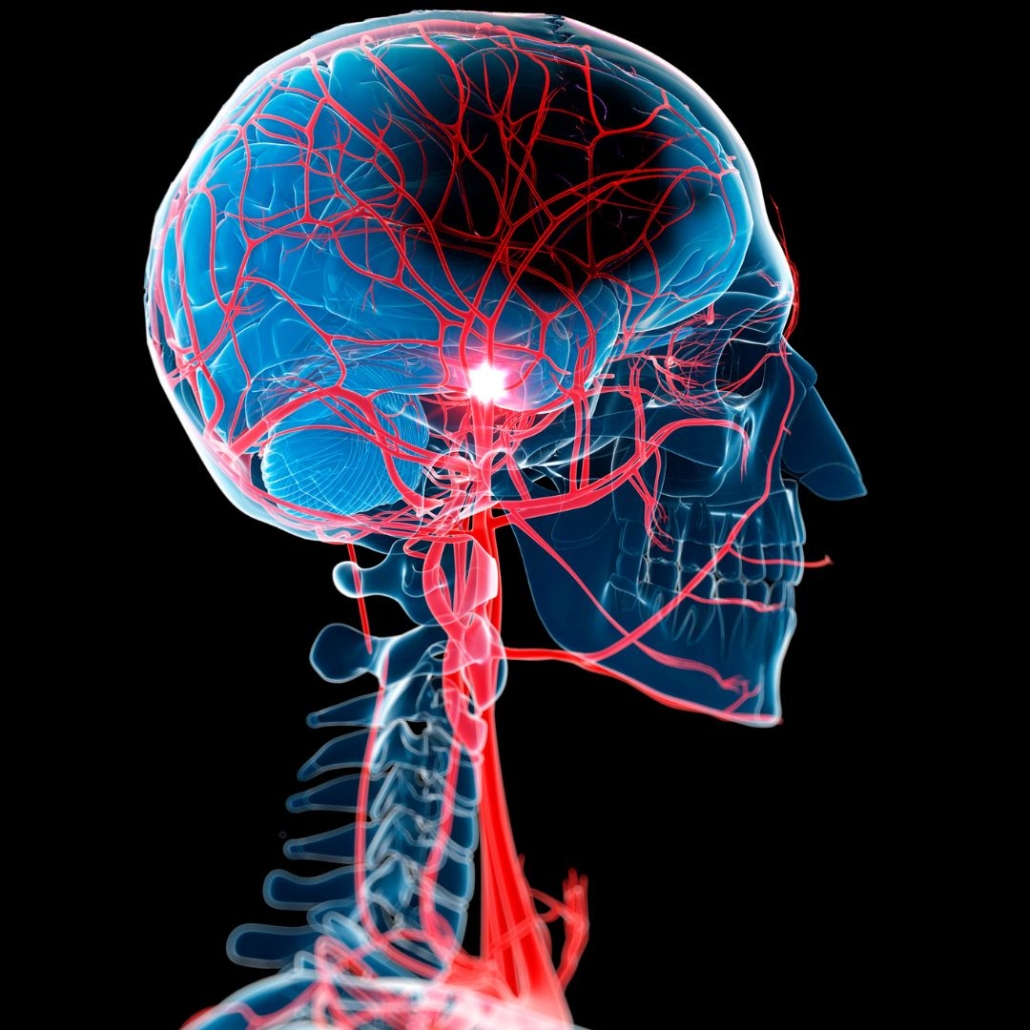 Starting anticoagulation following cardioembolic stroke with Elan ...