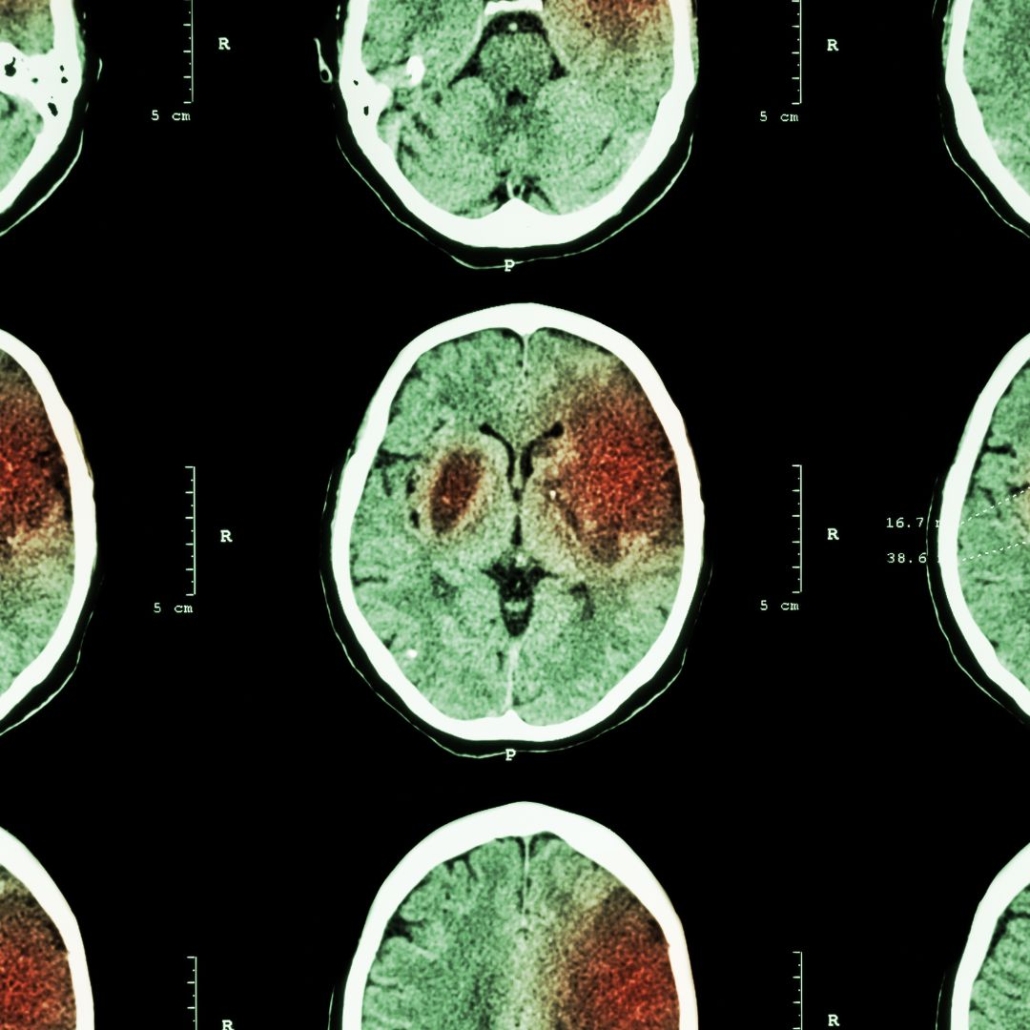 Home - European Stroke Organisation
