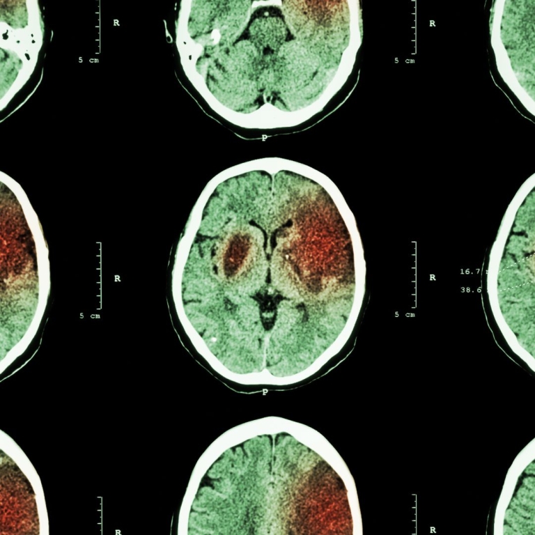 Home - European Stroke Organisation