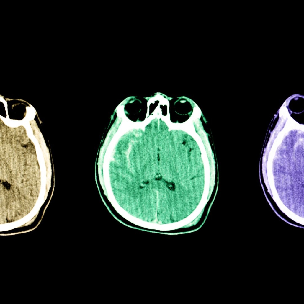 Preventing Secondary Brain Injury in Subarachnoid Hemorrhage by Lumbar ...