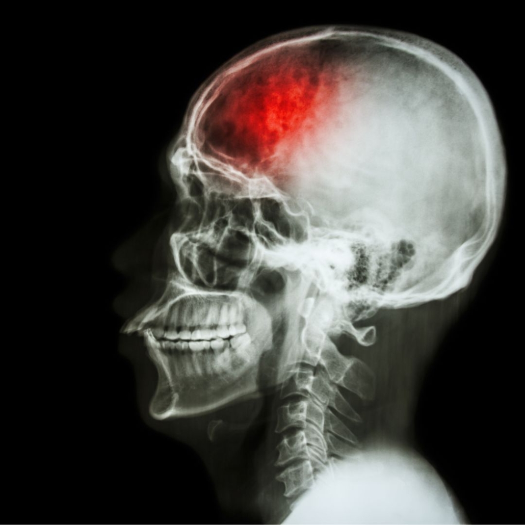 Reperfusing Large Core Stroke - European Stroke Organisation