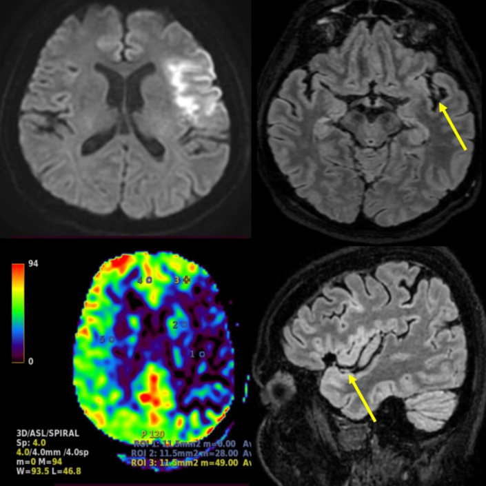 Slow-flow in acute ischaemic stroke - European Stroke Organisation