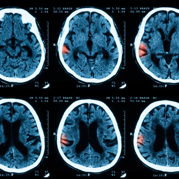 Home - European Stroke Organisation