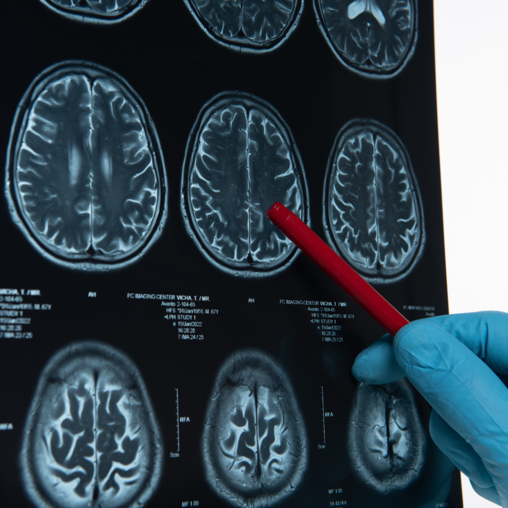 Cancer-related stroke: When to suspect and how to treat? - European ...