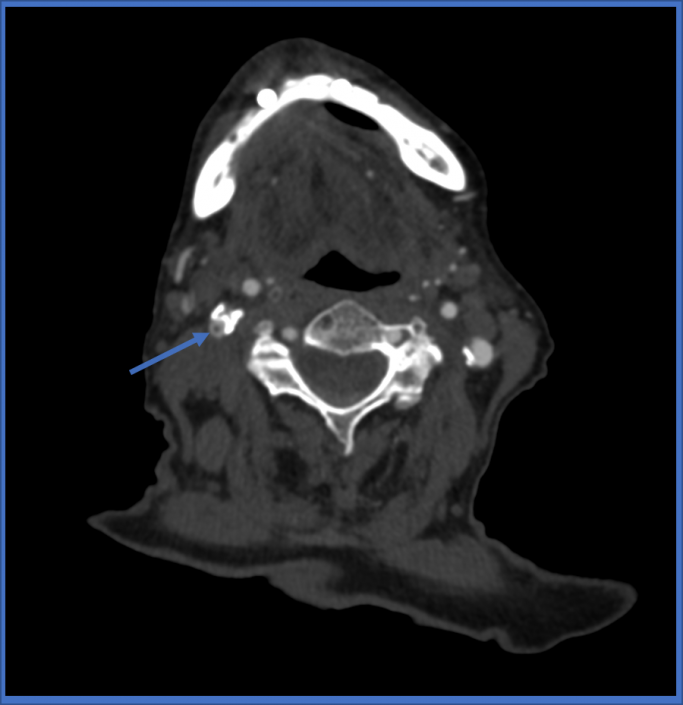 Medical Management of Free-Floating Carotid Thrombus: an Open Call for ...